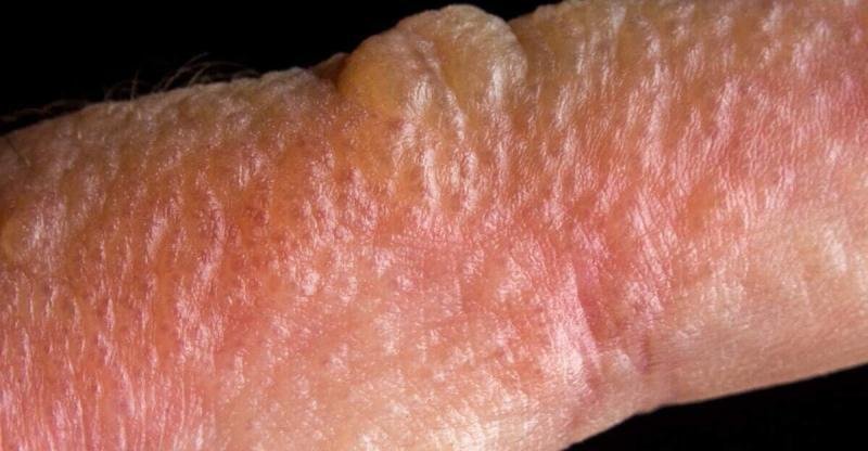 Poison Ivy Rash: Causes, Treatment and Prevention - Natural Food Series